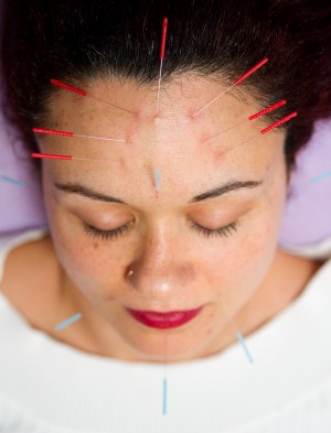 Acupuncture for the Treatment of Skin Disorders